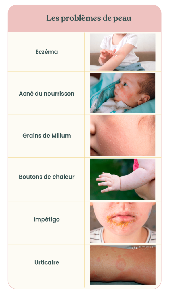 Boutons, plaques rouges et éruption cutanée bébé - May app